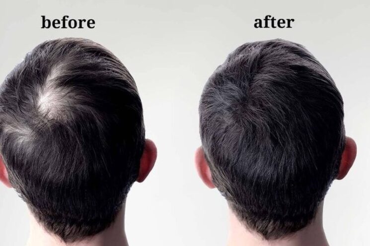 A Closer Look at the Different Types of Men’s Hair Pieces and Their ...